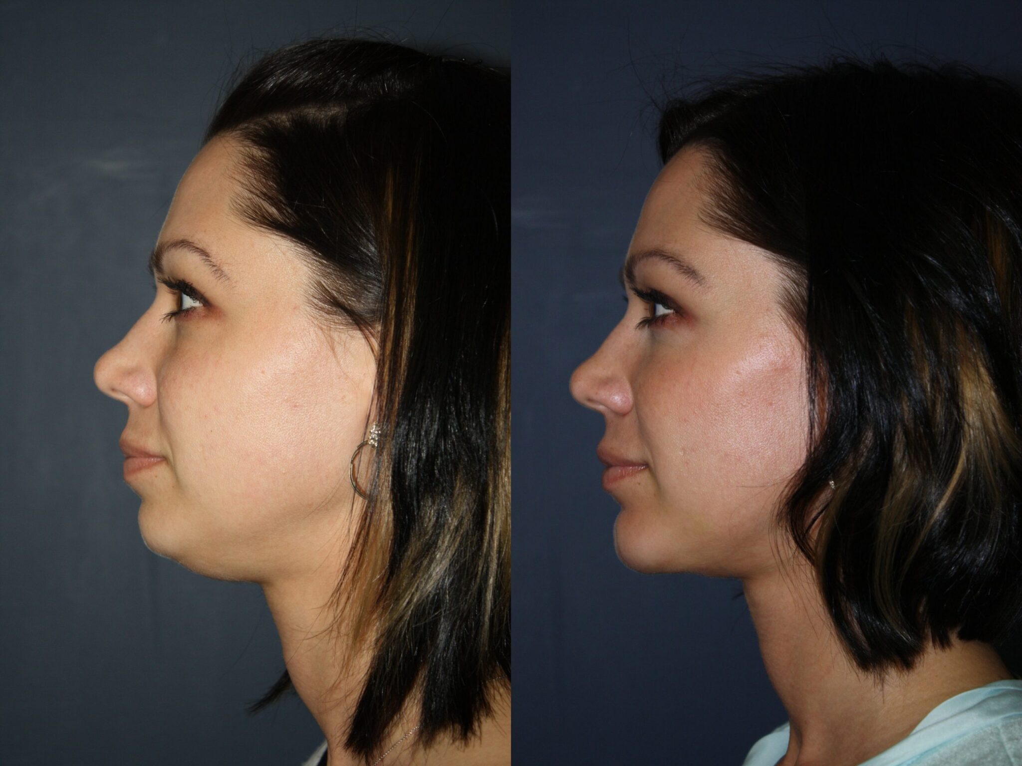 Double Chin And Plastic Surgery | Facial Plastic Surgery in Denver, CO