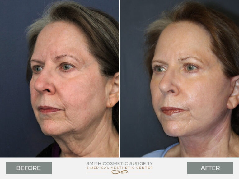 Ozempic Face Treatment Denver | Post Weight Loss Facial Plastic Surgery