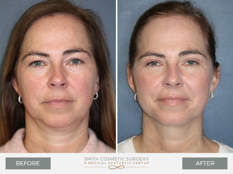 Eyelid Lift and Brow Lift Denver Before & After Photos | Facial Plastic ...